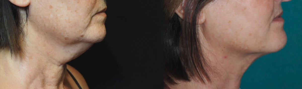 De-Aging Effect - Key Biscayne Magazine